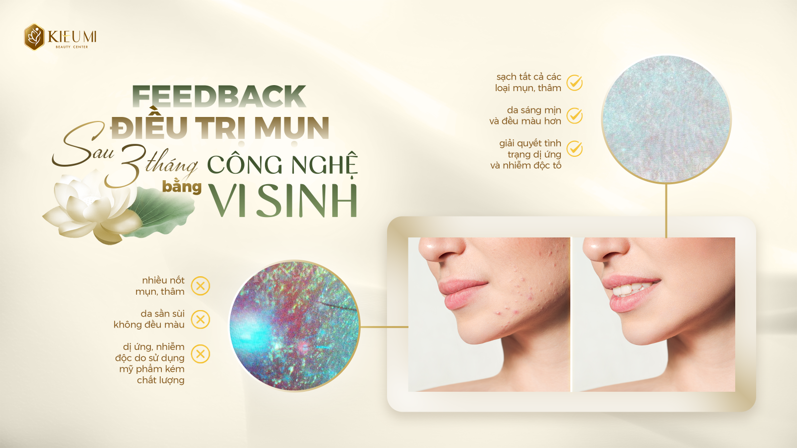 Khám Phá Nguyên Nhân & Phương Pháp Trị Mụn Từ Gốc Tại Kiều Mi Beauty